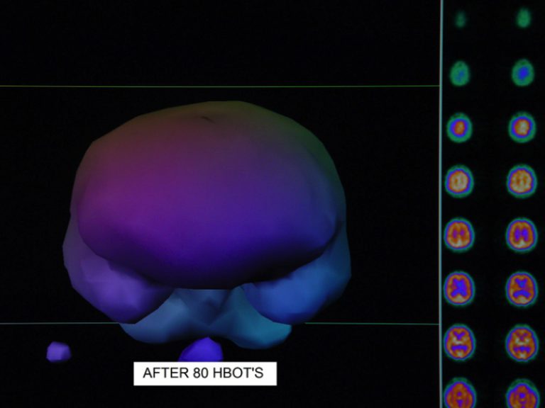 Stroke | Harch Hyperbaric Oxygen Therapy