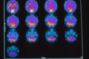 SPECT Imaging | Harch HBOT (Hyperbaric Oxygen Therapy)