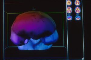 SPECT Imaging | Harch HBOT (Hyperbaric Oxygen Therapy)